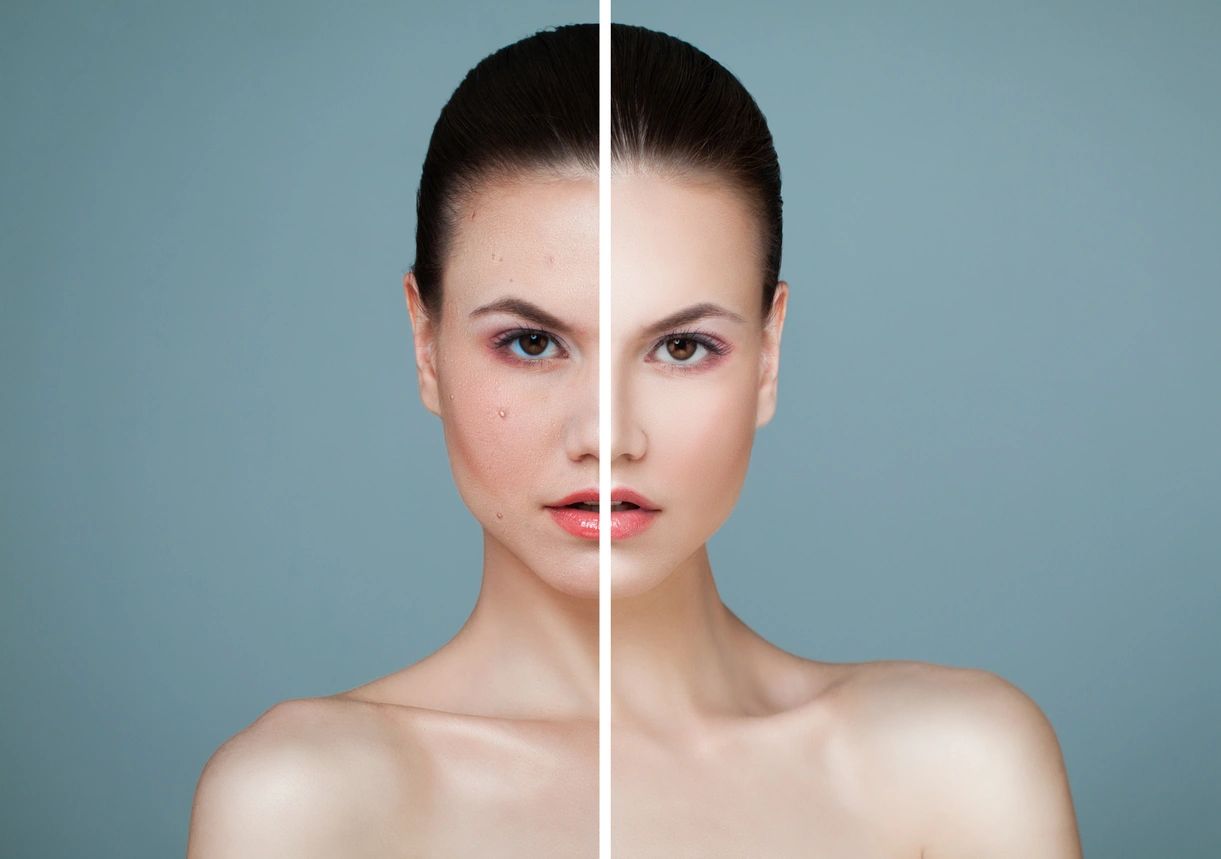 NON-MELANOMA SKIN CANCER PATIENTS ARE AT HIGHER RISK FOR OTHER CANCERS ...